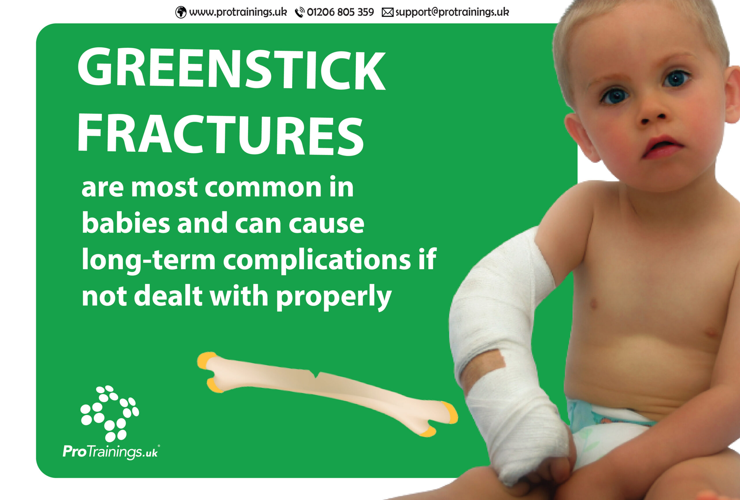 Greenstick fractures